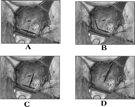 Cesarean Section Incision Types