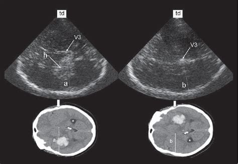 Figure 1 From Sonographic Monitoring Of Midline Shift Predicts Outcome