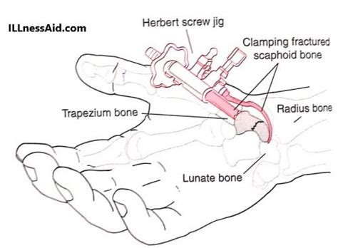 Scaphoid Fracture Examination Treatment And More Illnessaid