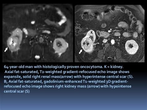 Solid Renal Masses Imaging