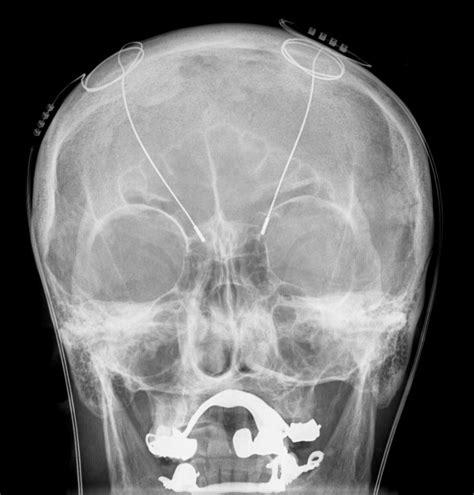 The Magic Switch Deep Brain Stimulation Could Cure Parkinson S Disease