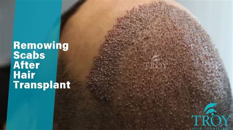 Removing Scabs After Hair Transplant Troy Hair