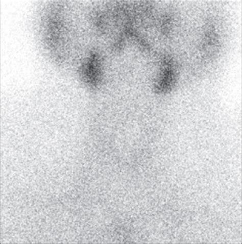 Transient Autoimmune Thyroiditis Associated With Sweets Syndrome Indian Journal Of