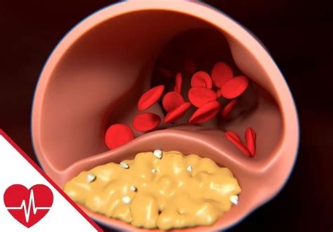 Arteriosklerose Was Ist Artierienverkalkung Kardionetzwerkde