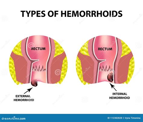 Hemorrhoidal Node Stock Illustrations 7 Hemorrhoidal Node Stock