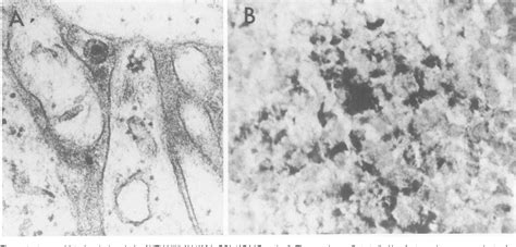Figure 1 From Htlv Iiilav Viral Antigens In Lymph Nodes Of Homosexual