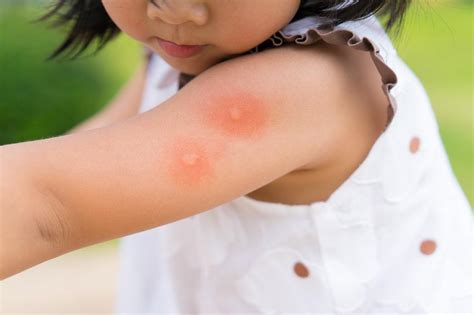 9 Ways To Prevent Mosquito Bites This Summer Macomb Medical Clinic