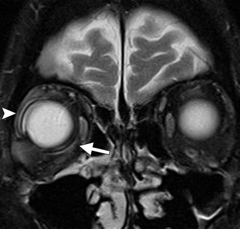 Ct Of Scleral Plaques