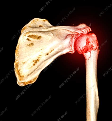 Fractured Shoulder Ct Scan Stock Image F037 7174 Science Photo Library