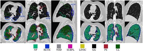 Automated Full Lung Classification Results Of Two Ct Scans With Download Scientific Diagram