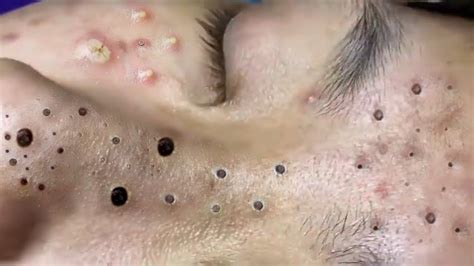 Blackhead Extraction Removal 12 Jannettedermatology Youtube