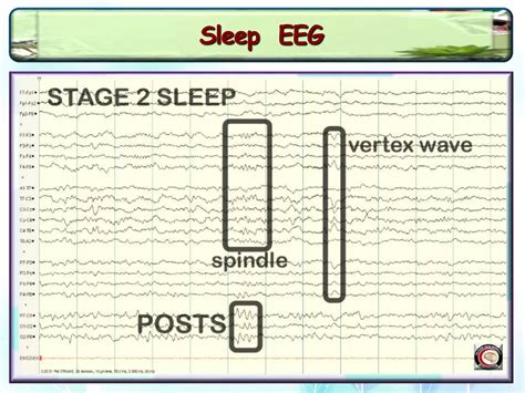 Polysomnogram Interpretetion Pptx