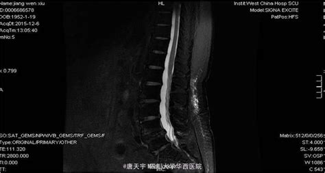 腰痛1年加重伴右下肢麻木6月余