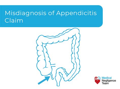 Misdiagnosis Of Appendicitis Claim Medical Negligence Team