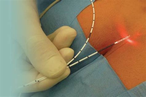 Laser Pilonidal Sinus Treatment In Pcmc Pune Apex Multispeciality Hospital