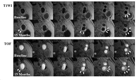Figure 2 From Predictors Of Progression In Intraplaque Hemorrhage Volume In Patients With