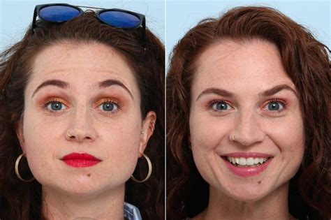 Botox® Cosmetic And Xeomin Photos Houston Tx Patient 10367