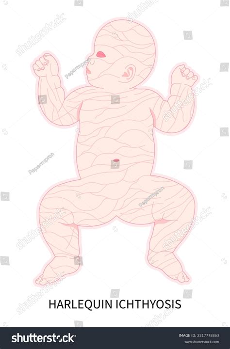 Congenital Ichthyosis Over 2 Royalty Free Licensable Stock