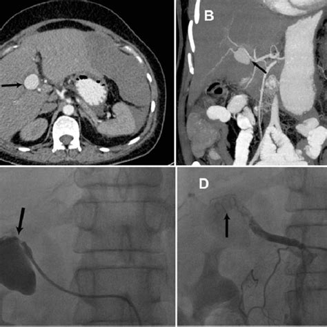 E A Ct Scan Of Post Cholecystectomy Female Patient With High Grade