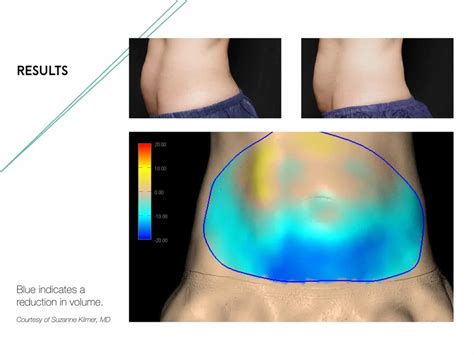 Laser Lipo In Sylva NC Non Invasive Fat Reduction