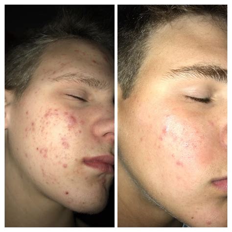 After 8 Months Of Ampicillin Clindamycin Phosphate And Tretinoin Gel