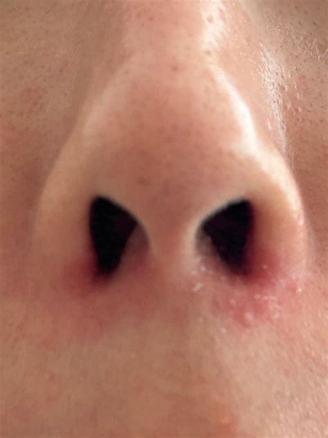 코 수포 헤르페스 지식in