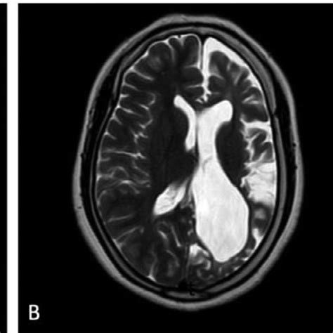 Mri Showing Hyperpneumatization Of Right Frontal Sinus Blue Arrow As