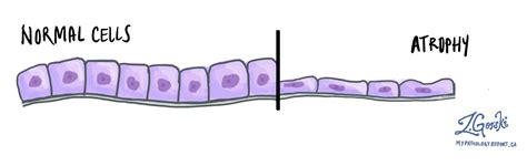 Atrophic Mypathologyreportca