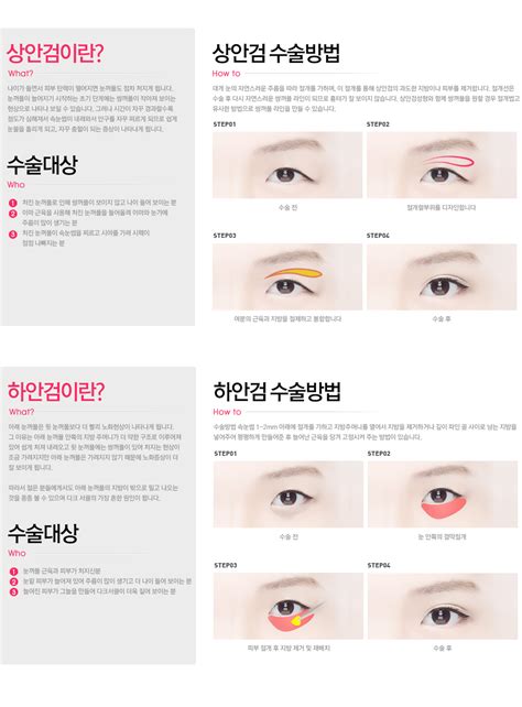 Lh성형외과 눈성형 안검성형술