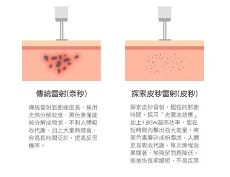 Discovery Pico皮秒雷射 婕登美學時尚診所