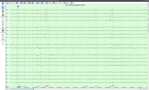 Spike Detection Slide 1 Persyst