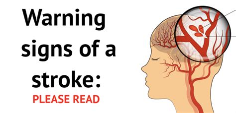 Warning Signs Of A Stroke Please Read