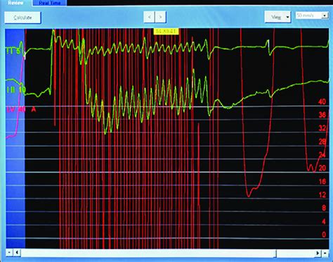 Case 2 Catheterizaton Laboratory Monitor Showing Ecg Artifacts
