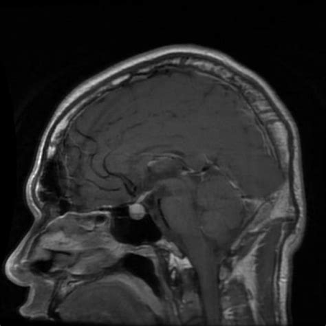 Brain Classification Dataset And Pre Trained Model By H452