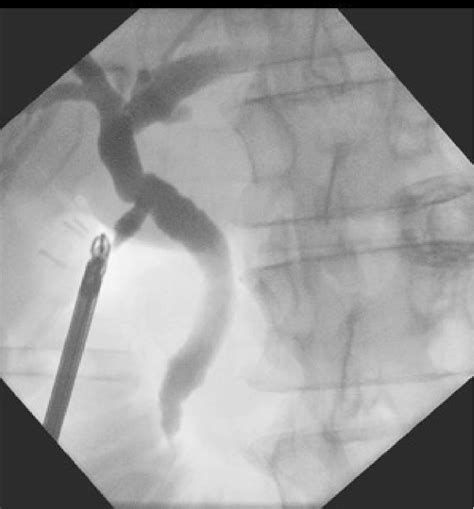 Post Exploration Cholangiogram Download Scientific Diagram