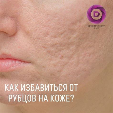 Рубцы на коже как избавиться виды лечение консультация
