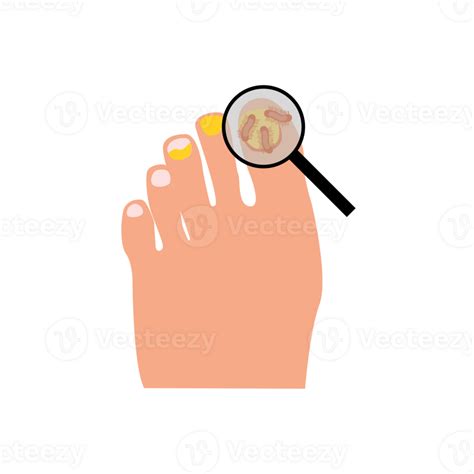 Onychomycosis Feet With Nail Disease Fungal Nails Infection Doctors