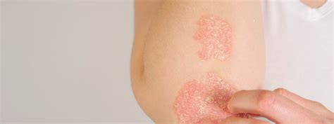Eczema Is Common During Pregnancy Heres What You Can Do