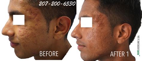 Microneedling For Acne Scarring 207 Laser And Integrative Med