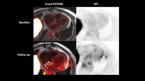 68ga Dotatate Hybrid Positron Emission Tomographymagnetic Resonance