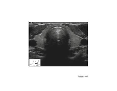 Transverse Bilateral Thyroid Image Dms 164 Final — Printable Worksheet
