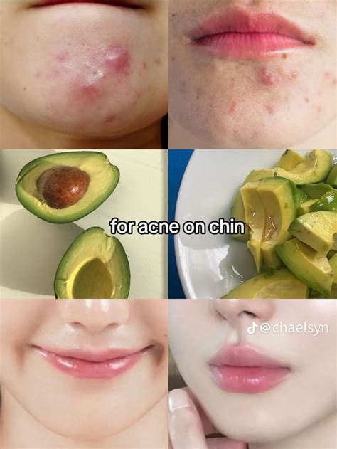 Pin By Erin On Pins By You In 2024 Skin Care Tips Beauty Treatments