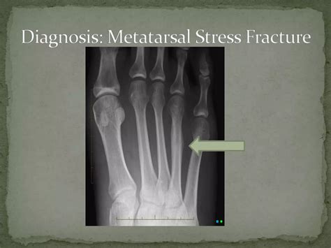 Metatarsal Stress Fracture Ppt
