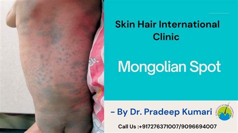Mongolian Spot 10 Mongolian Spot Spiritual Meanings Plus Birthmark