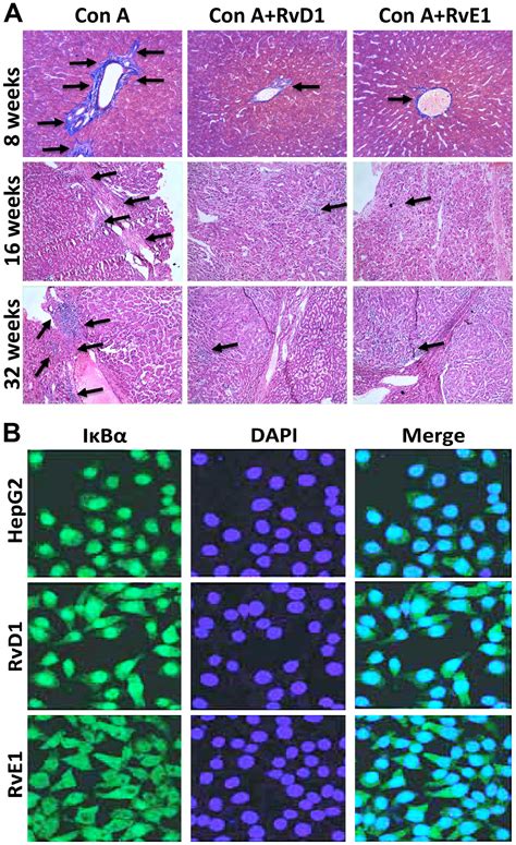 Resolvin D1 And E1 Alleviate The Progress Of Hepatitis Toward Liver Cancer In Long Term