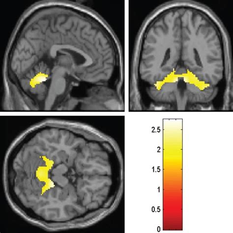 Significant Negative Correlation Between Cerebellar Gray Matter Volume