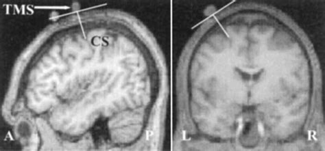Position And Orientation Of Tms Coil Tms Relative To The Central