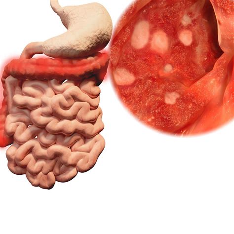 Managing Pancolitis Valery Martino