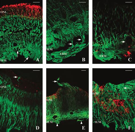 Epiretinal A C And Subretinal D F Glial Remodeling In Human Rd A Download Scientific