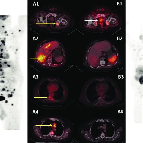MIP Image Of Whole Body 18 F Fluorodeoxyglucose Positron Emission